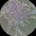 Candida albicans – scheda micologica ed approfondimenti