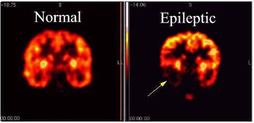 Epilessia - descrizione della patologia ed approfondimenti