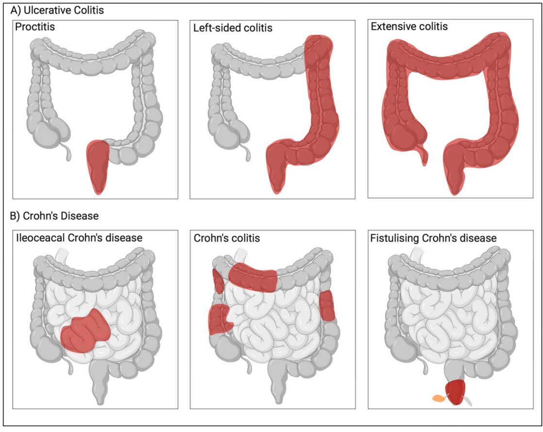 Malattia Infiammatoria cronica intestinale (IBD): quanto sappiamo