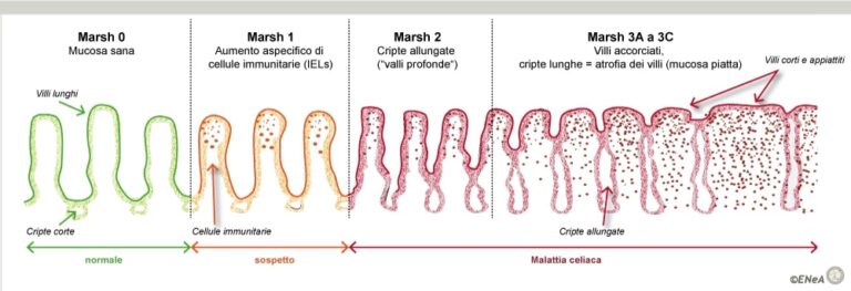 Malattia celiaca (Celiachia): Caratteristiche generali