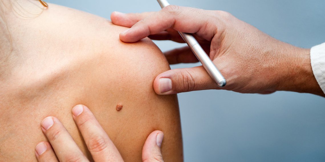 Nei sospetti: come riconoscere quelli a rischio