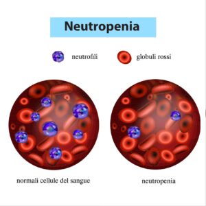 Neutropenia: Cosa Causa la Carenza di Globuli Bianchi?
