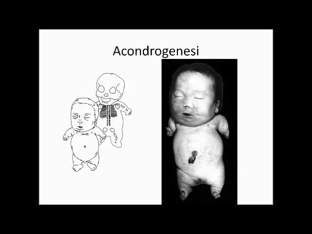 Rara Patologia Scheletrica: Scopri l'Impatto dell'Acondrogenesi