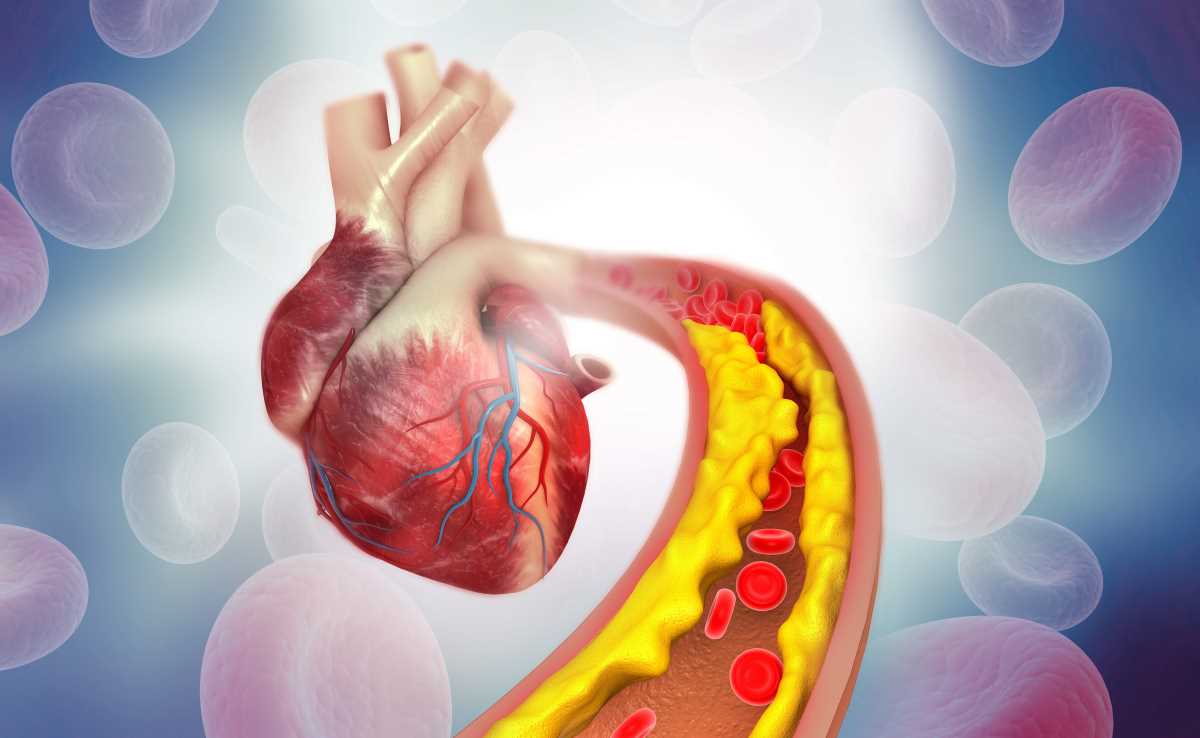 Come prevenire il modo efficace il colesterolo alto?