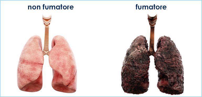 Tumore ai Polmoni e il Collegamento Incontestabile con il Fumo