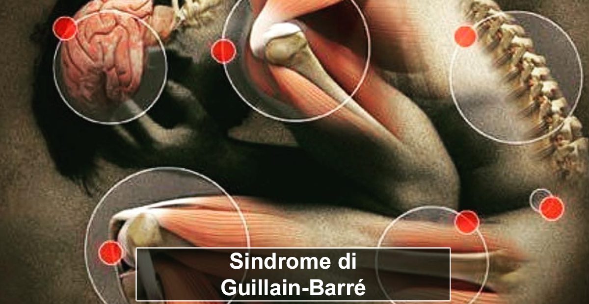 Affrontare la Sindrome di Guillain-Barré: Dalle Cause ai Trattamenti