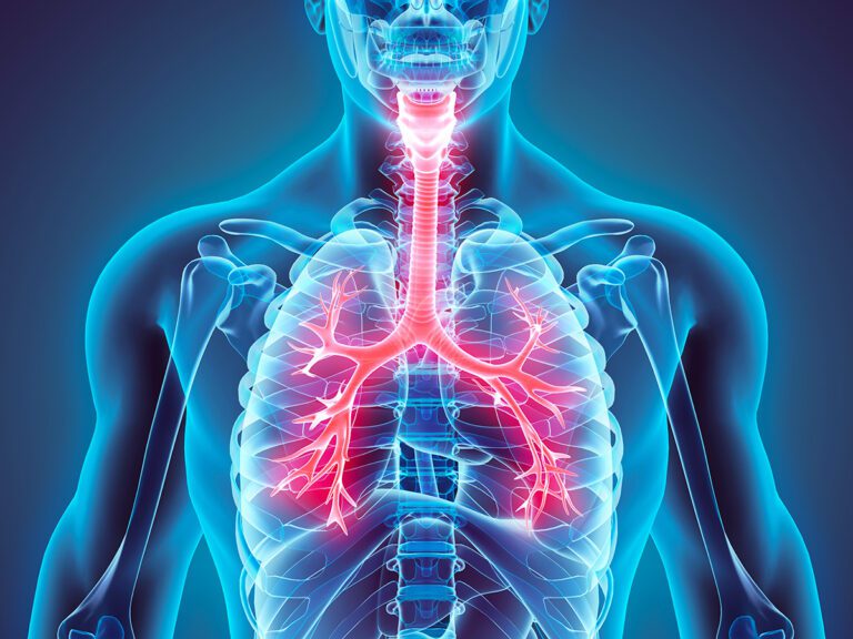 Antibiotico per Bronchite: Quando e Quali Opzioni Ci Sono?
