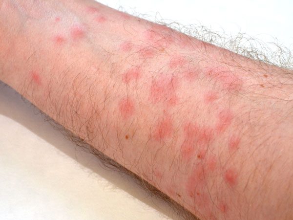 Lesioni cutanee da acari: cause, sintomi e trattamenti