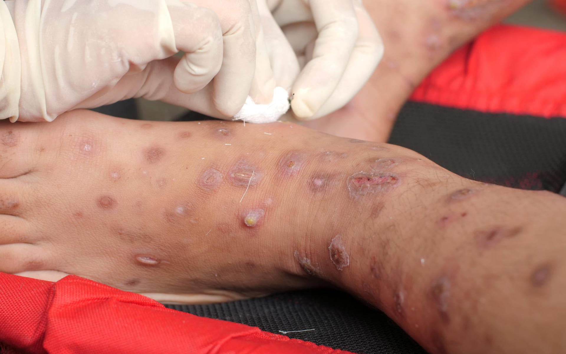 Pericolo di contrarre la scabbia: tutto ciò che devi sapere ...