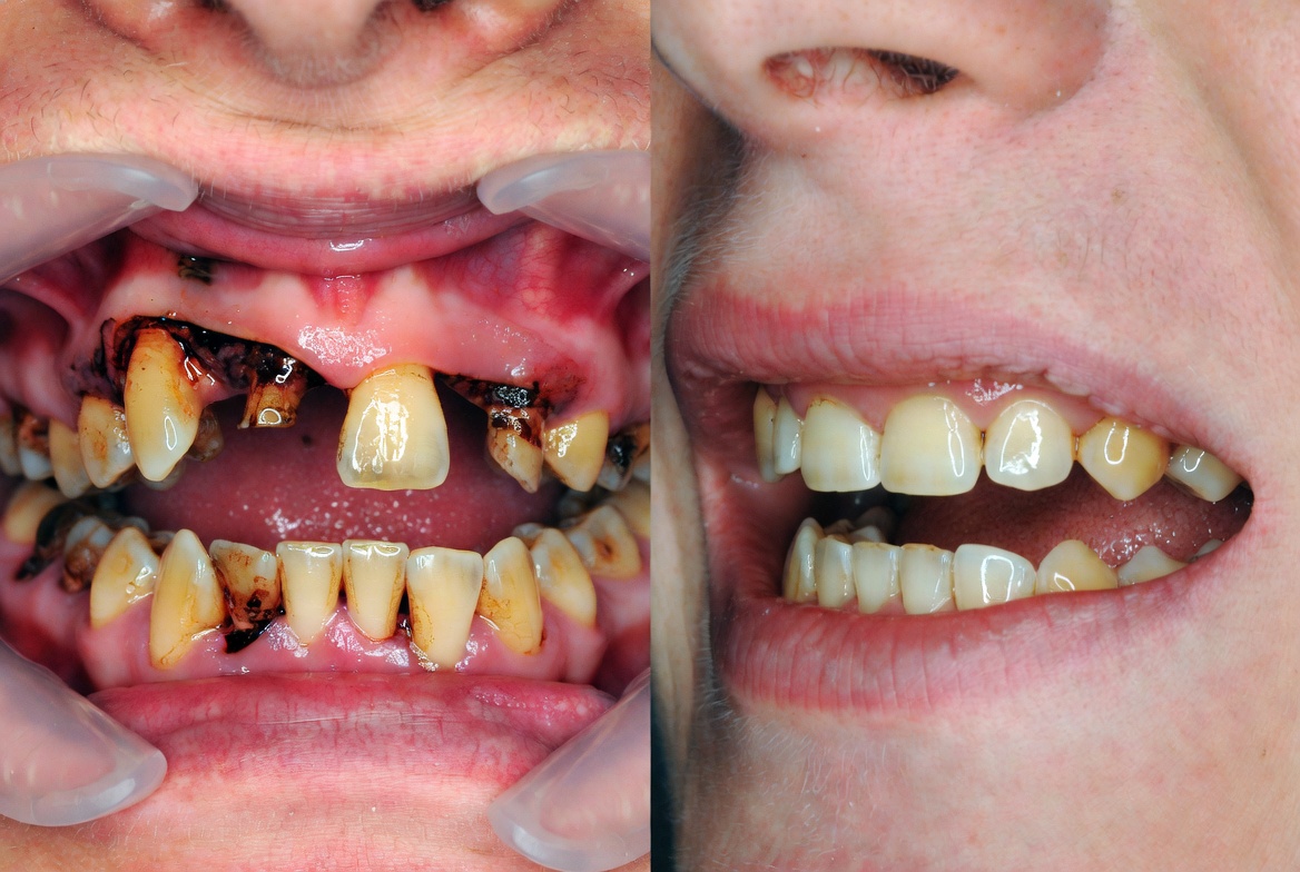 Svapo peggiore del fumo per denti e gengive
