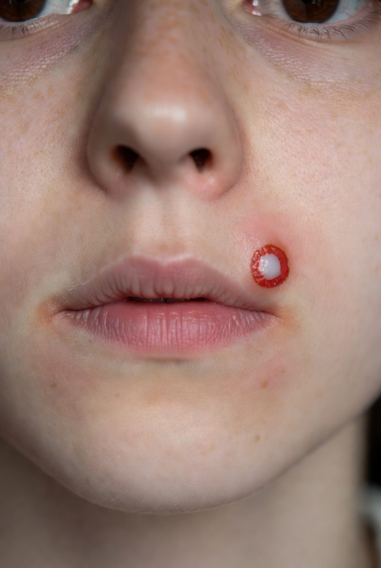 Pustole con Pus sul Viso - Microbiologia Italia