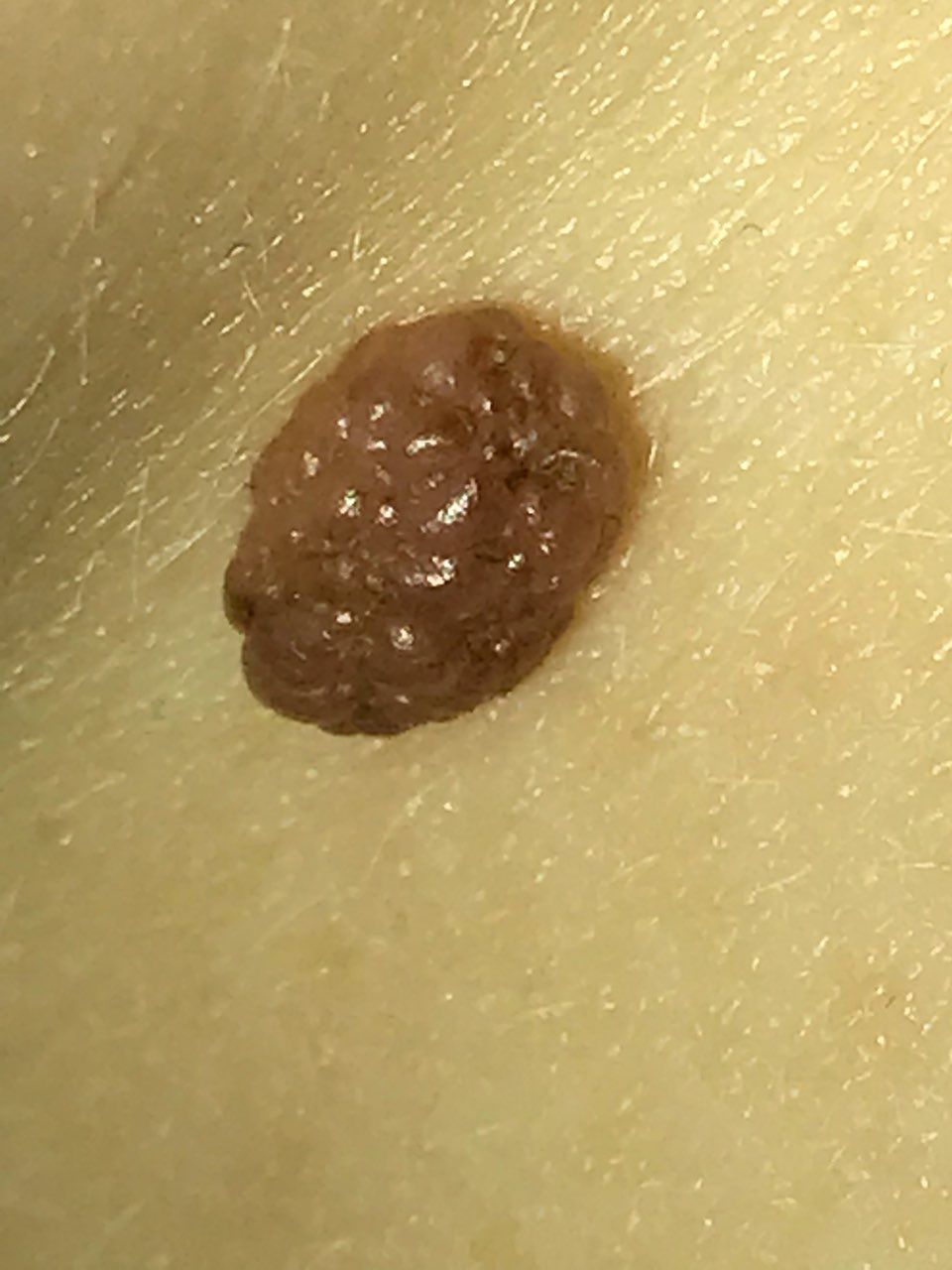 Nevo Dermico Papillomatoso: Sono Pericolosi?